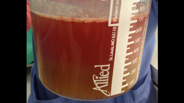 Chronic Seroma – Breast Diagnosis and Treatment Options | Dr. Stuart A ...